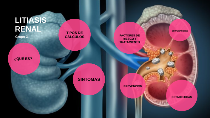LITIASIS RENAL by Lucía González Robles on Prezi