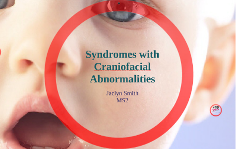 Syndromes with Craniofacial Abnormalities by jaclyn smith on Prezi