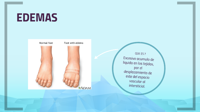 EDEMAS by liseth gonzalez on Prezi