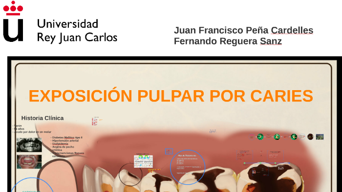 Caso de Exposición pulpar por caries by Juan Francisco Peña Cardelles ...