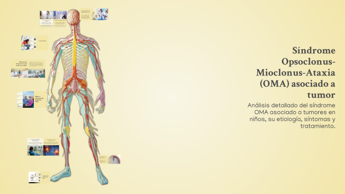 Síndrome Opsoclonus-Mioclonus-Ataxia (OMA) asociado a tumor by jose´h ...