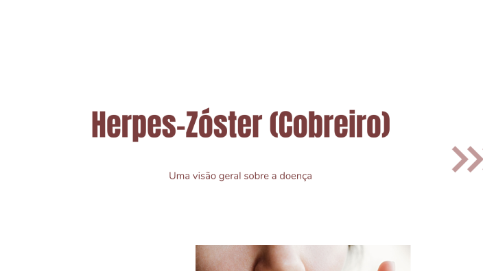 Herpes-Zóster (Cobreiro) by yasmin nobre on Prezi