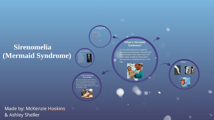 Sirenomelia (Mermaid Syndrome) by Ashley Sheller on Prezi