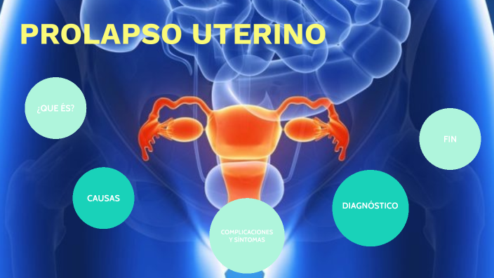 Prolapso uterino by Michael Estewart on Prezi