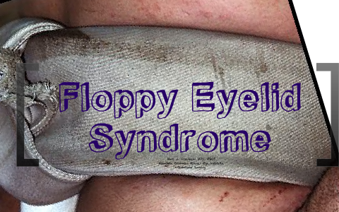 Floppy Eyelid Syndrome by marc hirschbein on Prezi