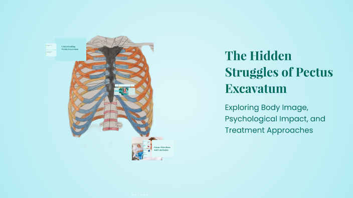 The Hidden Struggles of Pectus Excavatum by Emma Garofalo on Prezi