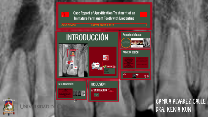 Case Report of Apexification Treatment of an by Camila Alvarez on Prezi