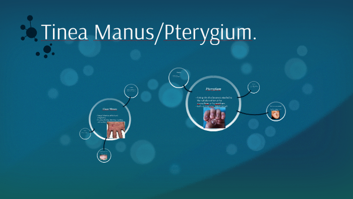 Tinea Manus/Pterygium. by abby white on Prezi