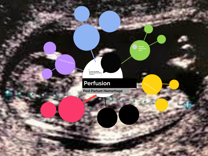 Post Partum Hemorrhage by Anna Sunderlin on Prezi