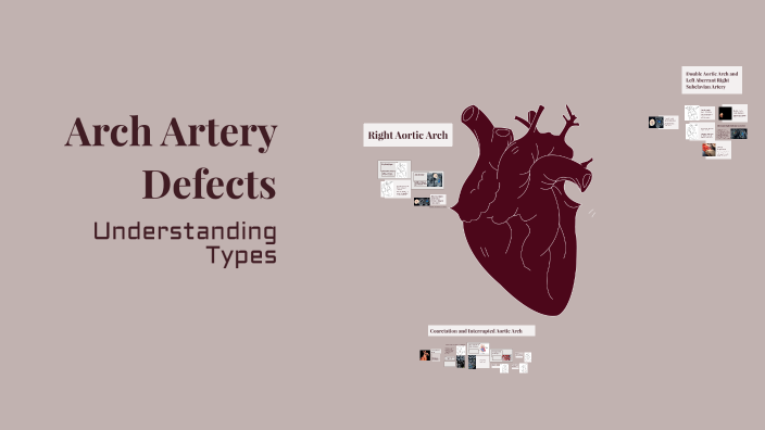 Arch Artery Defects by Emma Gilbertsen on Prezi
