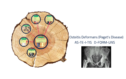 Osteitis Deformans (Paget's Disease) by Jess Buerster on Prezi