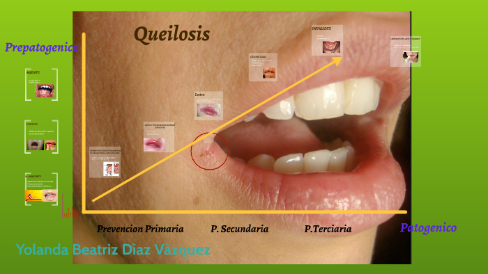 Queilosis by yolanda vazquez on Prezi