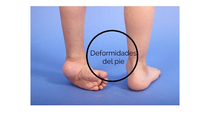 Deformidades del pie by Danitza Polo Miranda on Prezi