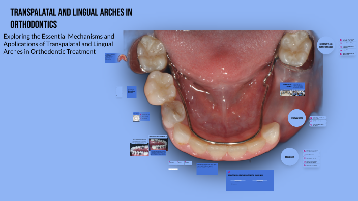 Transpalatal and Lingual Arches in Orthodontics by سديل سمرين on Prezi