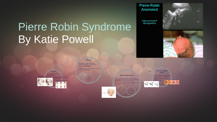 Pierre Robin Syndrome by Katie Powell on Prezi