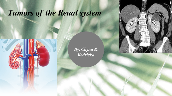 Tumors of the Renal system by chyna thornton on Prezi