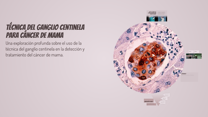 Técnica del Ganglio Centinela para Cáncer de Mama by Joana Martinez on ...