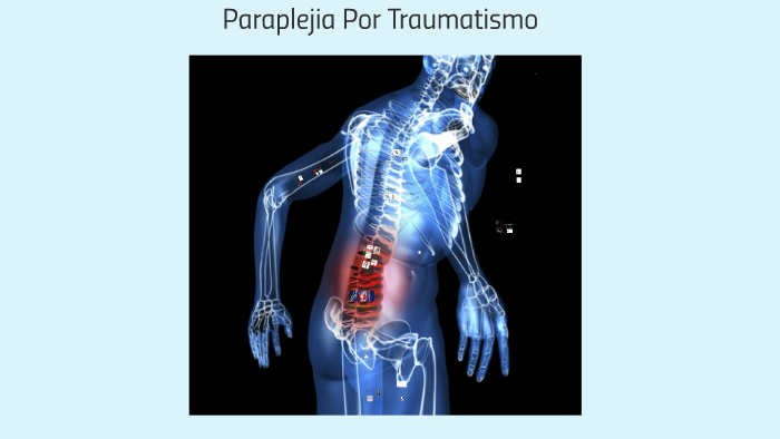 Paraplejia Por Traumatismo by Rafael Moreira on Prezi