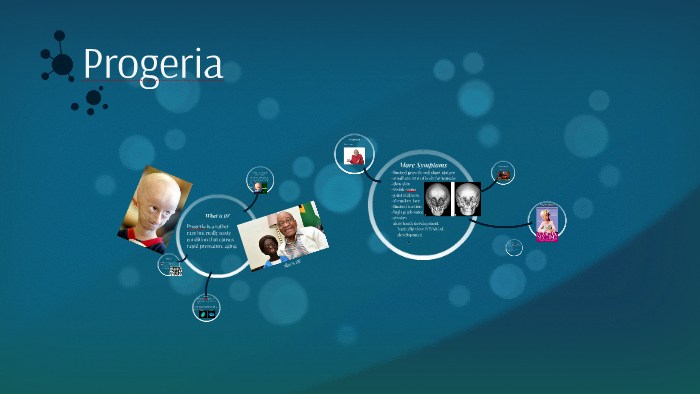 Progeria by The Real Guy The Best Guy on Prezi