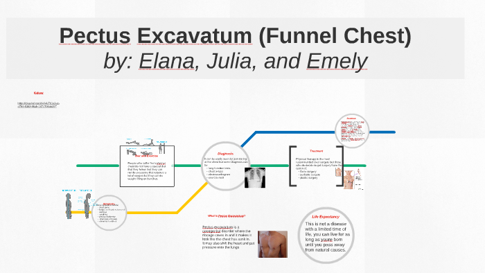 Pectus Excavatum (Funnel Chest) by Julia Souza on Prezi