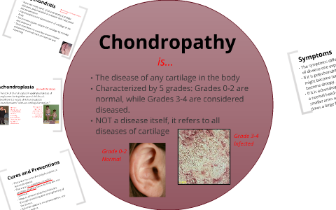 Chondropathy by Kevin Marquez on Prezi