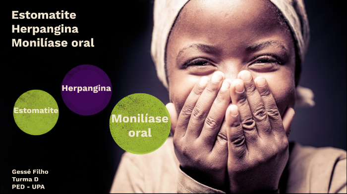 Gengivoestomatites x Herpangina x Monilíase oral by Gessé Moraes De ...