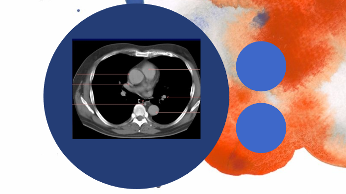 TAC DE TORAX NORMAL Y PATOLOGICO by heather Mariana Quinto Mina on Prezi