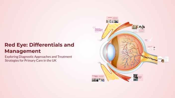 Red Eye: Differentials and Management by Aamna Arif on Prezi