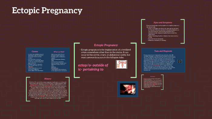 Ectopic Pregnancy by Sami Voss on Prezi