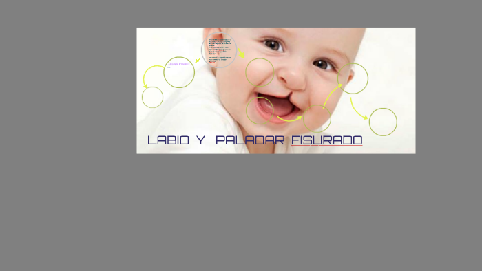 LABIO Y PALADAR FISURADO by brian zuñiga on Prezi