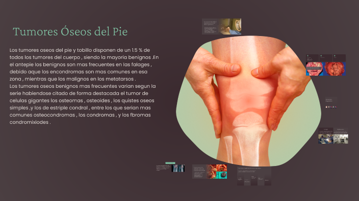 Tumores Óseos del Pie by goretti gonzalez on Prezi