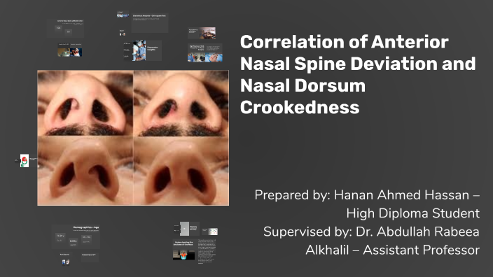 Correlation of Anterior Nasal Spine Deviation and Nasal Dorsum ...