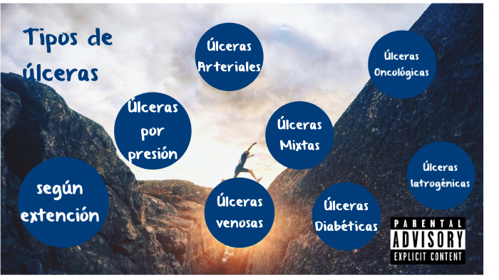 Tipos de ulceras by Heverth Daniel Bernal Nova on Prezi