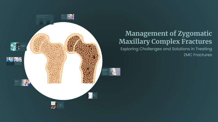 Management of Zygomatic Maxillary Complex Fractures by Soumya Desai on ...
