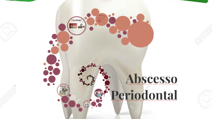Abscesso Periodontal by dara resende on Prezi