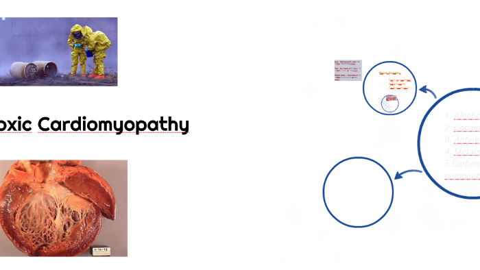 Toxic Cardiomyopathy by Laura Blau on Prezi