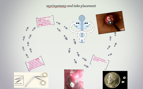 myringotomy and tube placement by brandi jermyn