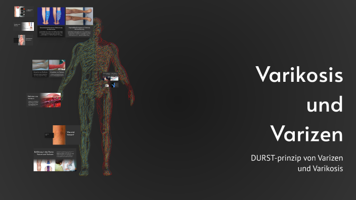 Varikosis und Varizen: Ursachen, Symptome und Therapie by Alejandra ...