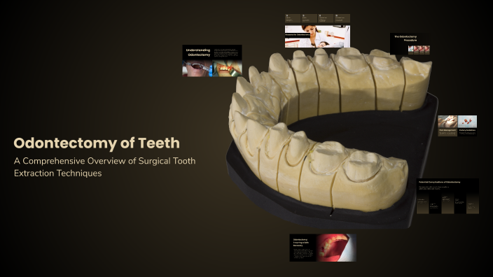 Odontectomy of Teeth by Dhia Thifal Malihah on Prezi