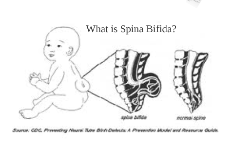 Spina Bifida Presentation (ED140) by Emily Rueger on Prezi