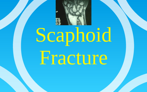 Scaphoid Fracture by Charlie Luscombe on Prezi