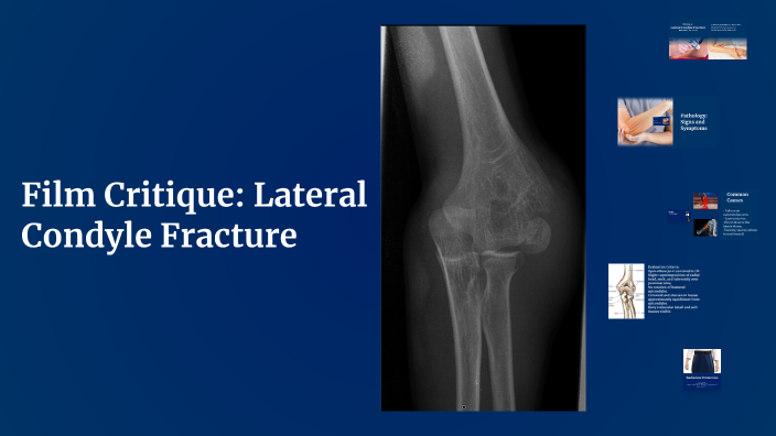 Film Critique: Lateral Condyle Fracture by Chris Rodriguez on Prezi