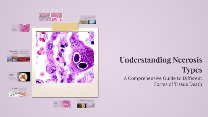 Understanding Necrosis Types by Eman Hadad on Prezi