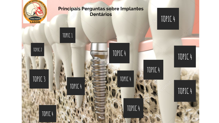 Principais perguntas sobre Implantes Dentários by Mateus Henrique on Prezi Principais perguntas sobre Implantes Dentários by Mateus Henrique on Prezi