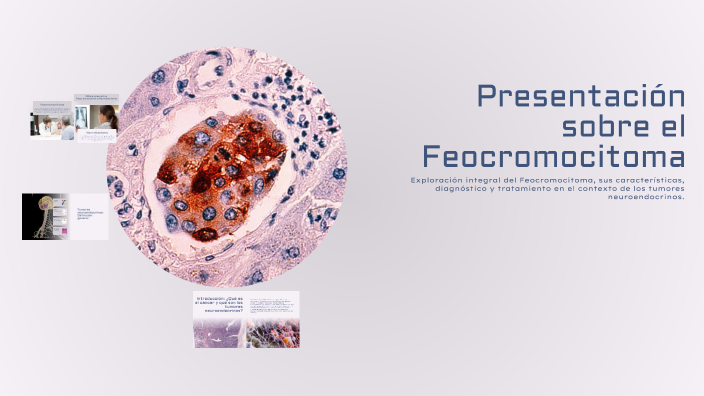 Presentación sobre el Feocromocitoma by Ángel Paniagua on Prezi