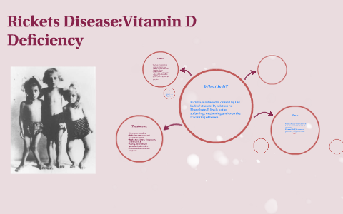 Rickets Disease:Vitamin D Deficiency by victoria walker on Prezi