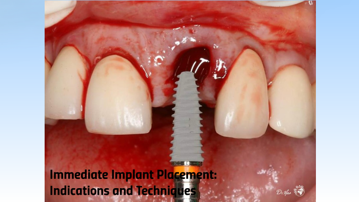 Immediate Implant Placement: Indications and Techniques by Mohamed ...