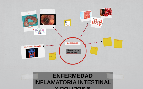 ENFERMEDAD INFLAMATORIA INTESTINAL Y POLIPOSIS by Pablo RIVERA PEREZ DE ...