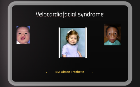 Velocardiofacial syndrome by Aimee Frechette on Prezi