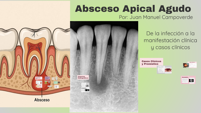 Absceso Apical Agudo by Juan Campoverde on Prezi